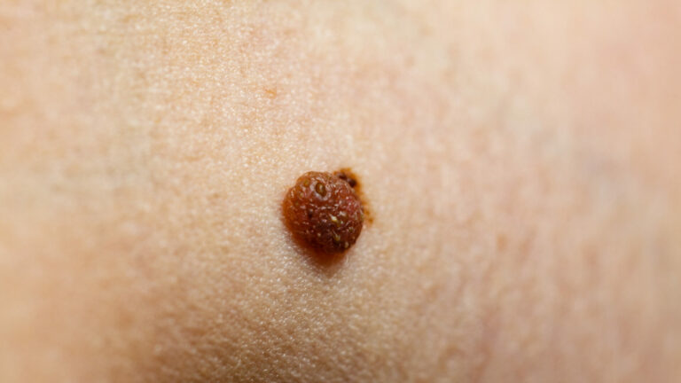 11 Signs It’s Time to Get Your Moles Checked Out by Your Dermatologist ...