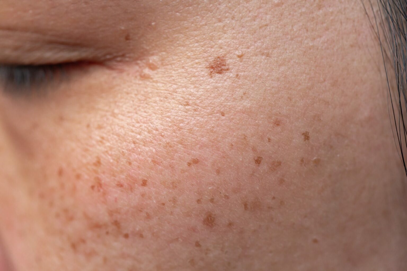 How to Get Rid of Age Bumps on the Face | Duncan Dermatology
